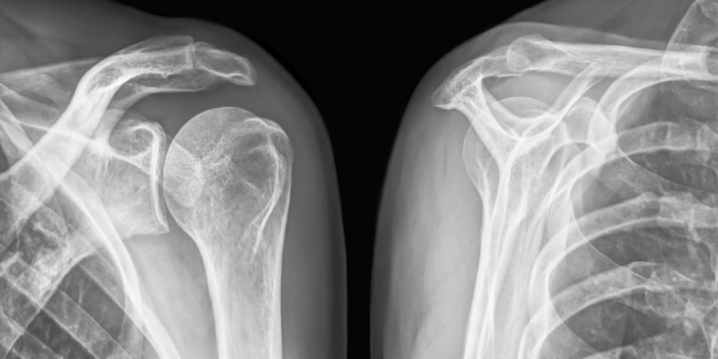 » Estiramientos para la síndrome subacromial y prevención de tendinitis ...